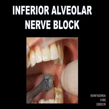 mandibular nerve-block