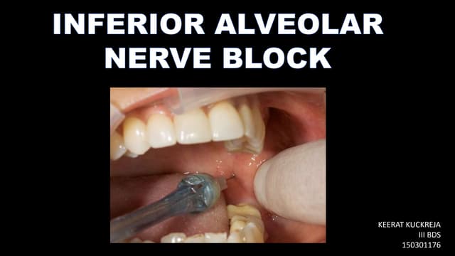Mandibular Anesthesia Inferior Alveolar Nerve Block Pptx