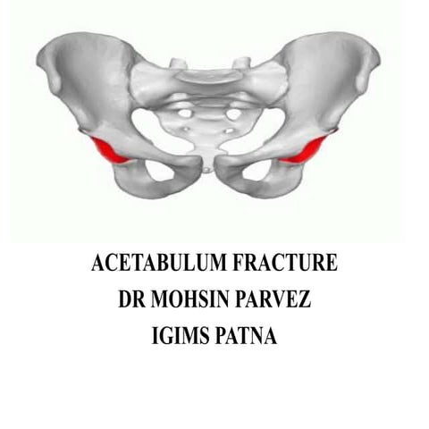 Acetabulum fractures | PPTX