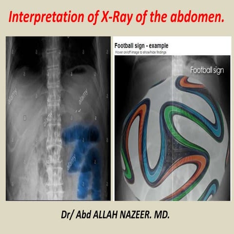 X ray signs of abdomen | PPTX