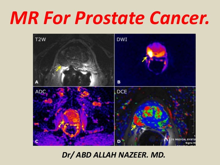 Presentation1 Mri Imaging Of The Prostate