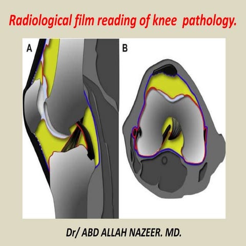 Presentation1, radiological film reading of knee joint. | PPTX
