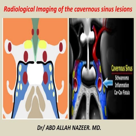 Presentation1, radiological imaging of cavernous sinus lesions. | PPTX