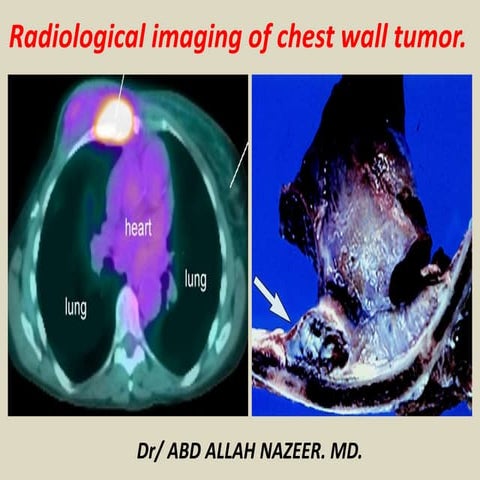 Presentation1, radiological imaging of chest wall tumour. | PPTX