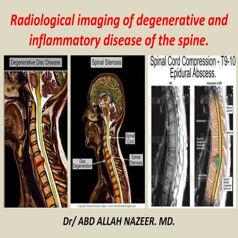 Transitional vertebrae radiology | PPTX