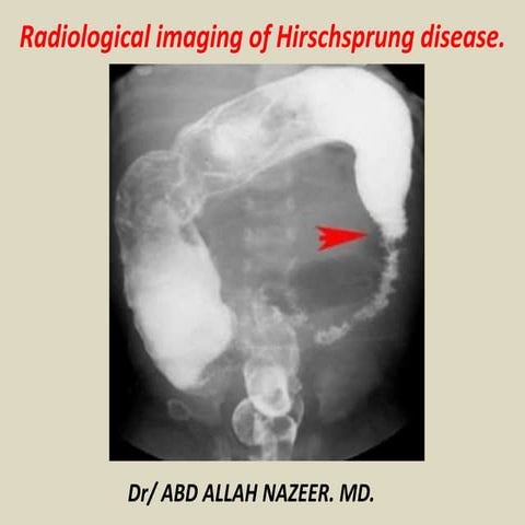 Hirschsprung Disease | PPT