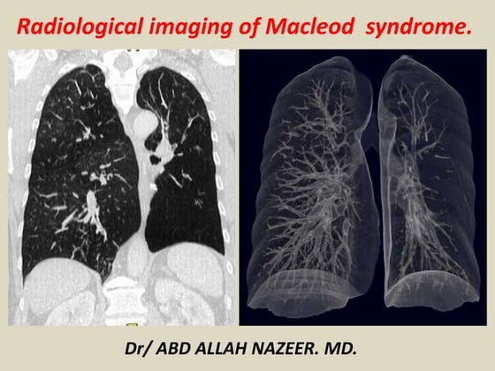 Presentation1, radiological imaging of leigh disease. | PPTX | Brain and Nervous System ...