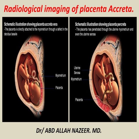 Presentation1, radiological imaging of placenta accreta. | PPTX