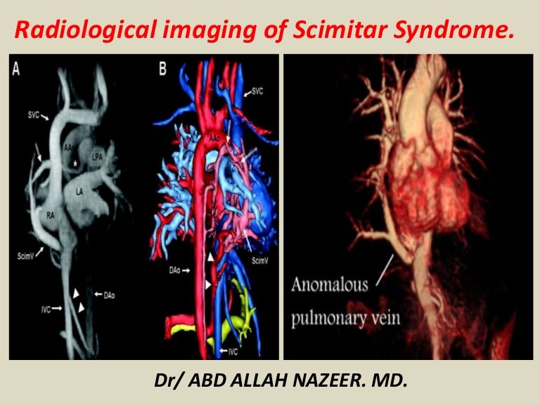Presentation1, radiological imaging of scimitar syndrome