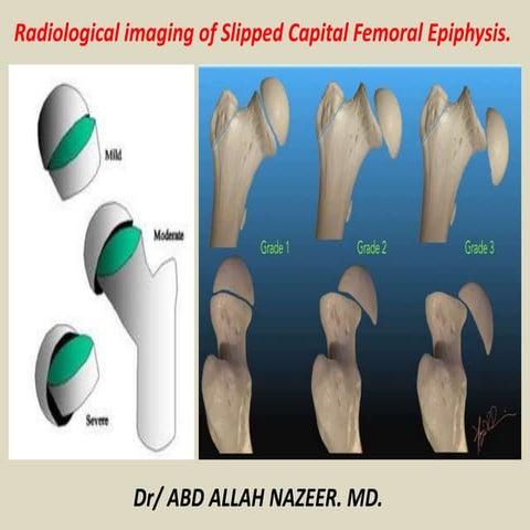 Presentation1, radiological imaging of slipped femoral capital ...
