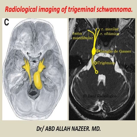 INTRA CRANIAL HEMORRHAGE- AGING BLOOD ON MRI | PPTX