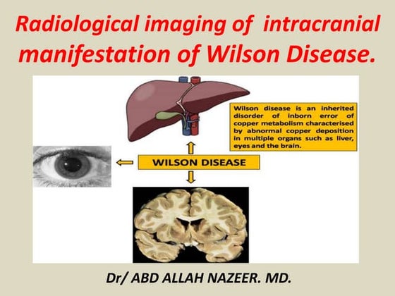 Wilson disease | PPT