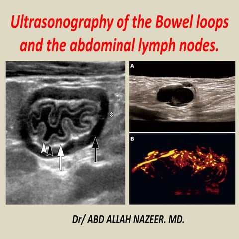 Acute appendicitis - Ultrasound first | PPTX
