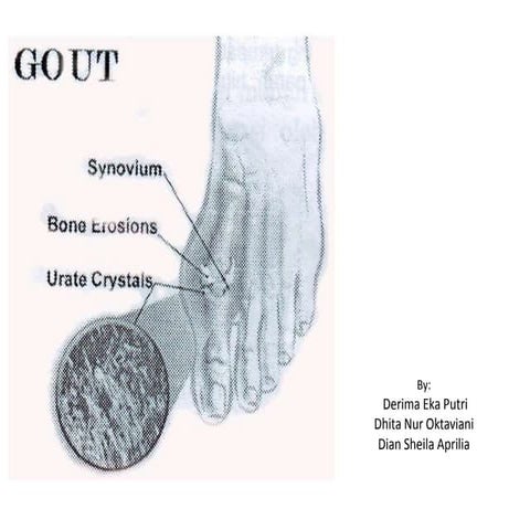 Artritis Gout | PPTX