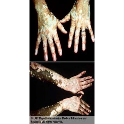 Michael Jackson and Vitiligo | PPSX