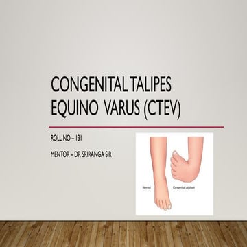 Congenital talipes equino varus Presentation (4).pptx