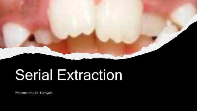 serial extraction | PPT