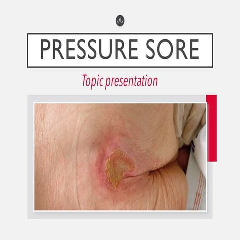 Pressure sore diagnosis and management for medical student | PDF
