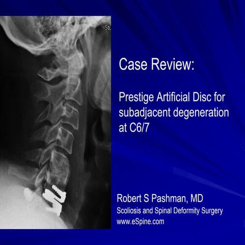 Case Review #6: 62 year old male presented with C5/6 Disc Herniation | PDF