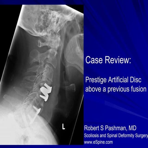 Case Review #4: Cervical Spine Surgery with Prestige Disc | PDF