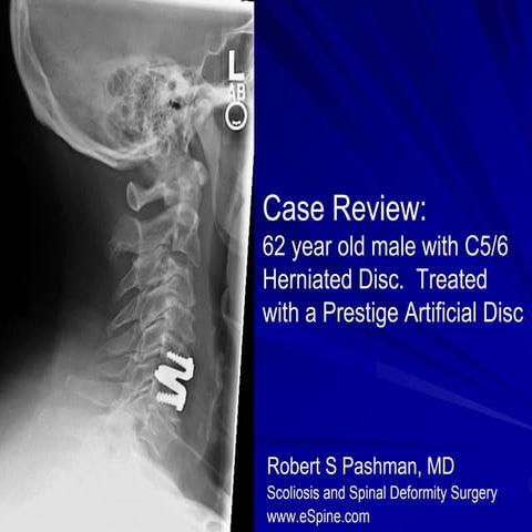 Case Review #6: 62 year old male presented with C5/6 Disc Herniation | PDF