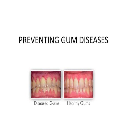 Preventing Gum Diseases | PPTX