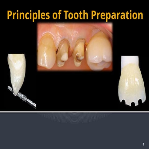 Principle of tooth preparation | PPTX