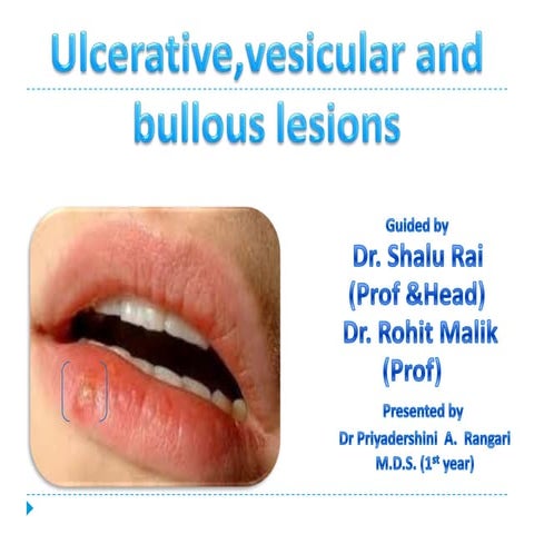 Priya seminar on ulcerative,vesicular and bullous lesions | PPTX