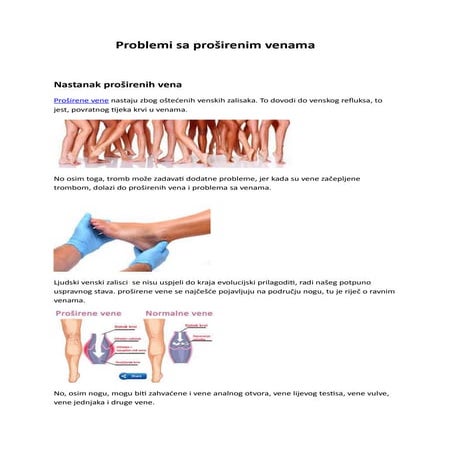 Problemi sa proširenim venama | PDF