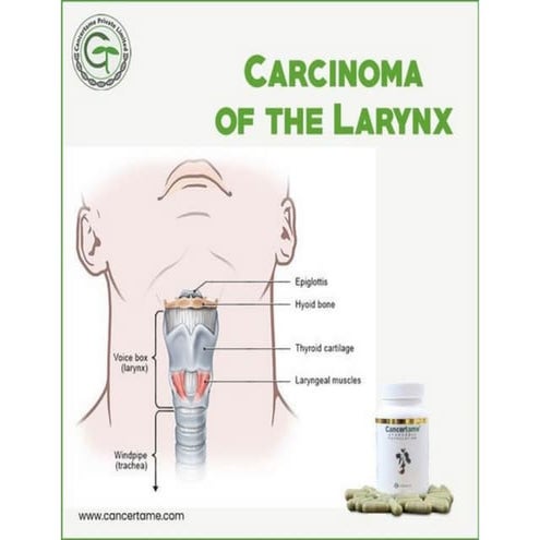 Carcinoma of the Larynx | PDF