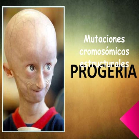 Progeria | PPTX