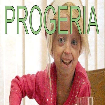 Progeria | PPTX