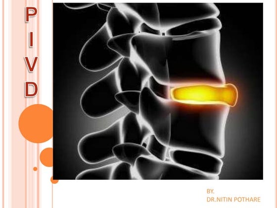 Plantar fascitis | PPT