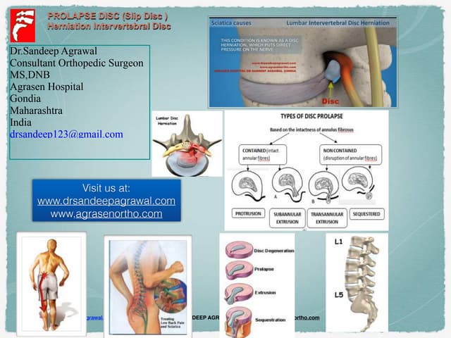 Herniated Nucleus Pulposus (HNP).pptx