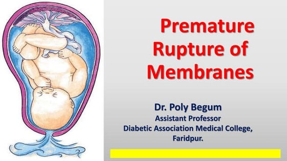 Premature rupture of membranes (PROM) | PPT