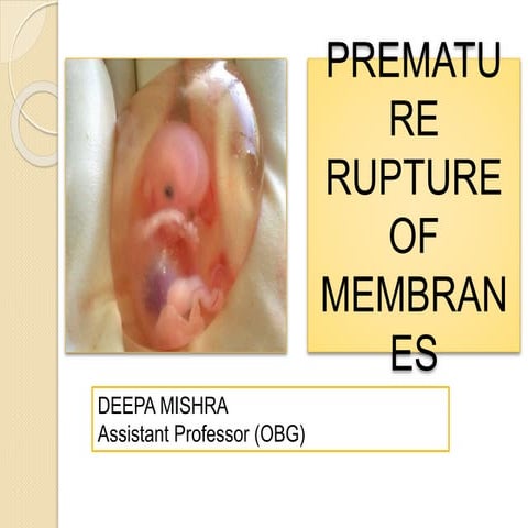 Premature rupture of membranes (PROM) | PPTX