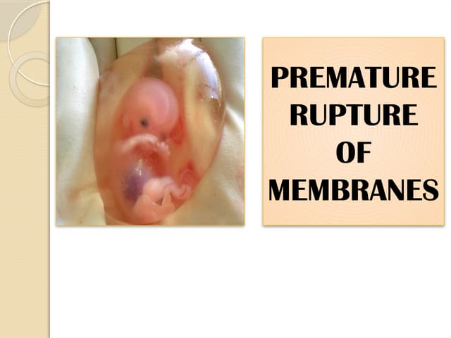 Premature rupture of membranes (PROM) | PPTX