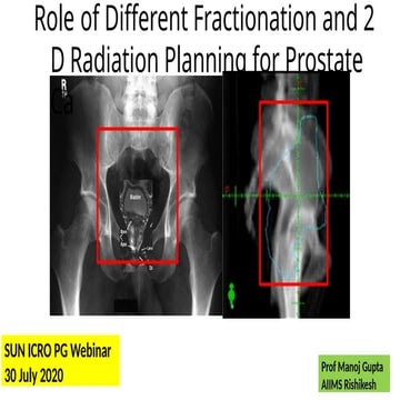 prostate ca 4.pptx RADIATION ONCOLOGY PPT | PPTX