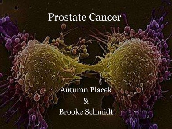 Prostate cancer.pptx