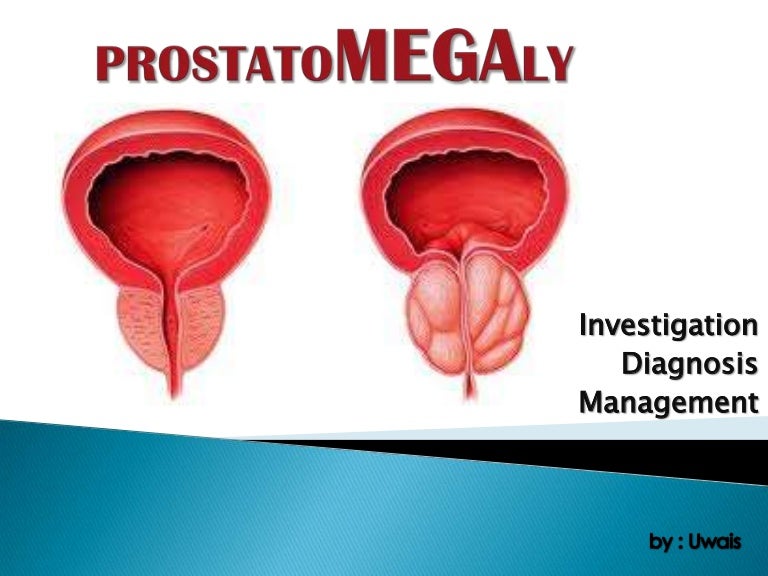 Prostatomegaly prostatomegaly
