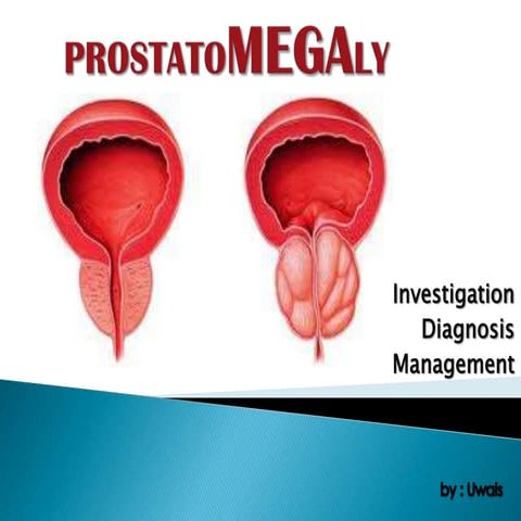 Prostate ultrasound (basic) | PPTX