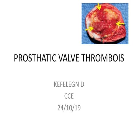 Prosthetic valve thrombosis | PPTX