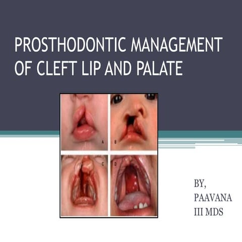 Prosthodontic management of cleft lip and palate | PPTX