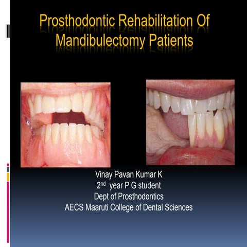 Prosthodontic Rehabilitation Of Mandibulectomy Pptx