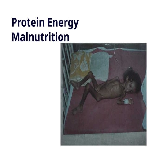 Protein Energy Malnutrition in Children.pptx