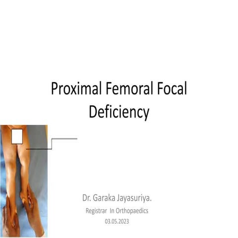 Proximal Femoral Focal Deficiency.pptx