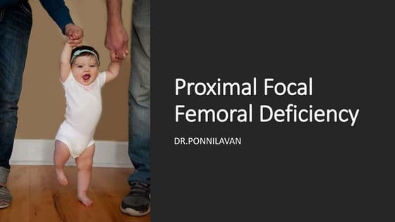 PFFD [proximal femoral focal deficiency] | PPTX