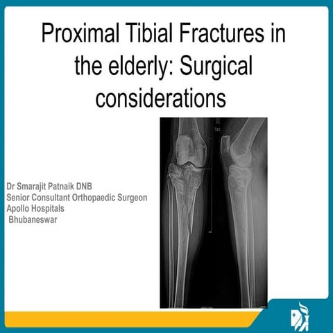 Proximal tibial fracture | PPT
