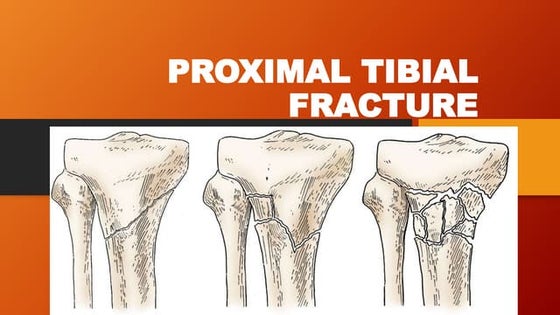 Updated_Orthopedic_Trauma_Classifications.pptx