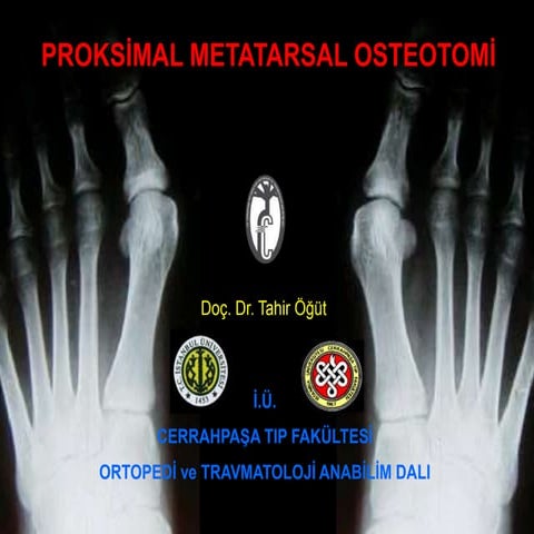 PROKSİMAL METATARSAL OSTEOTOMİ | PPT